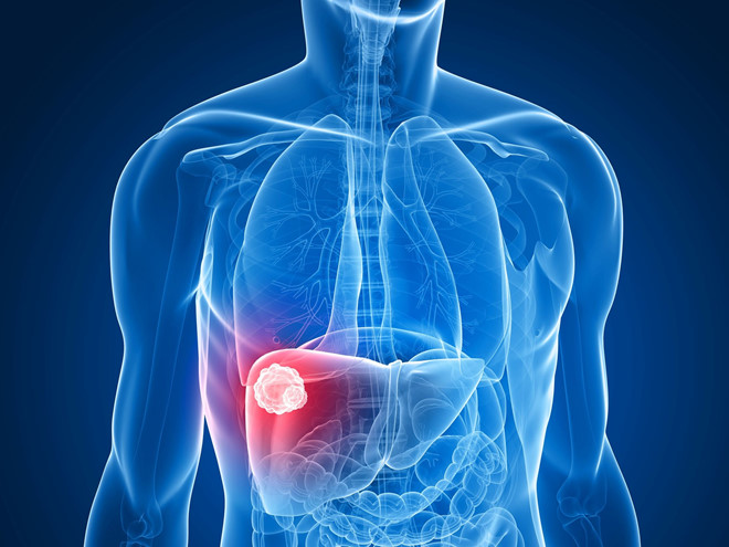 What Does The Size Of The Liver Calcification Say Vinmec