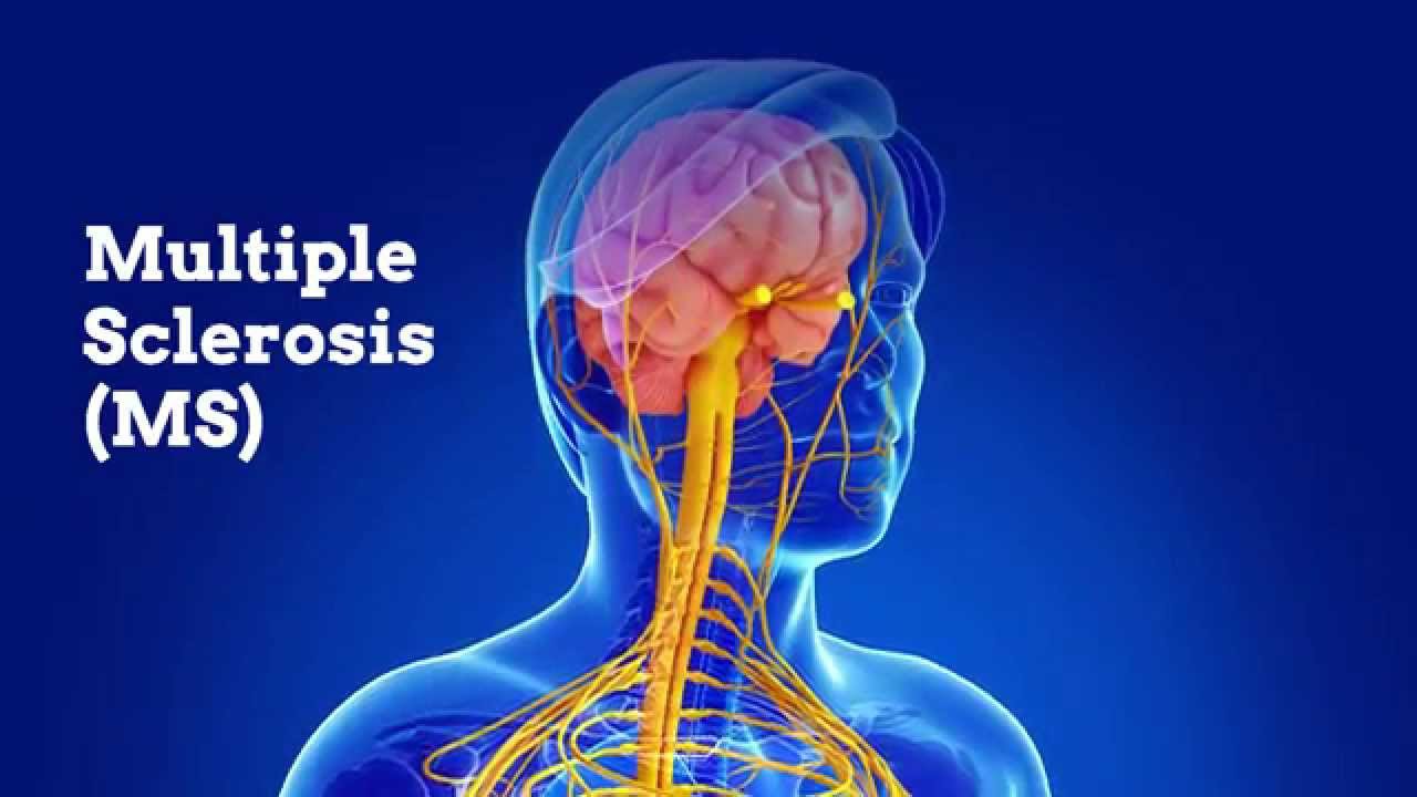 What Is Multiple Sclerosis Vinmec
