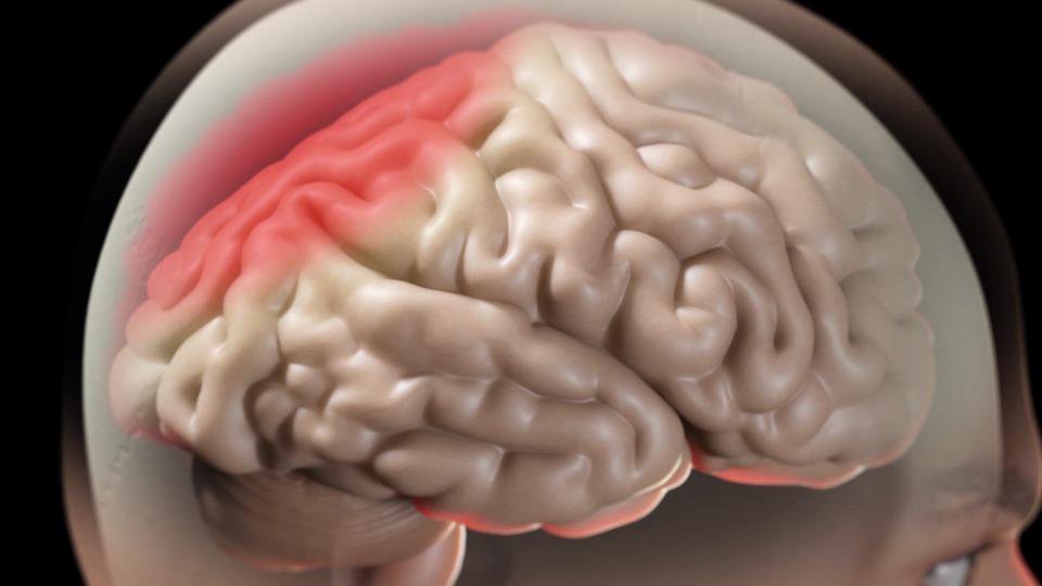 What Is Cerebral Edema Causes And Symptoms Vinmec