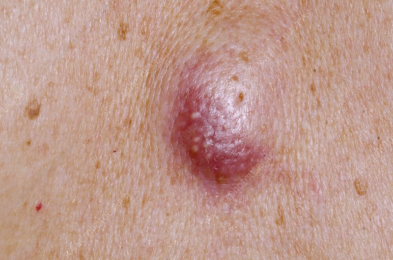 Epidermoid Cyst Sebaceous Cyst Vinmec Epidermoid Cyst Sebaceous Cyst Vinmec