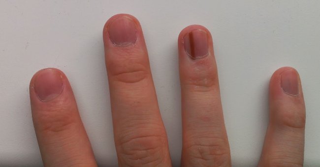 Are Long Black Stripes On Nails A Sign Of Cancer Vinmec are-long-black-stripes-on-nails-a-sign-of-cancer-vinmec