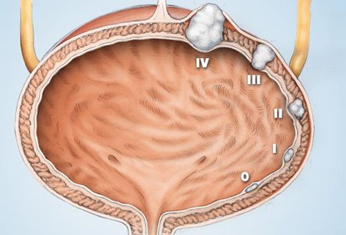 Laparoscopic resection of recurrent bladder tumor | Vinmec