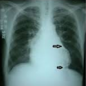 Các bất thường bóng tim trên X quang | Vinmec