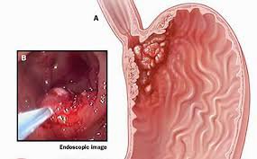 Diagnosis and treatment of duodenal cancer | Vinmec