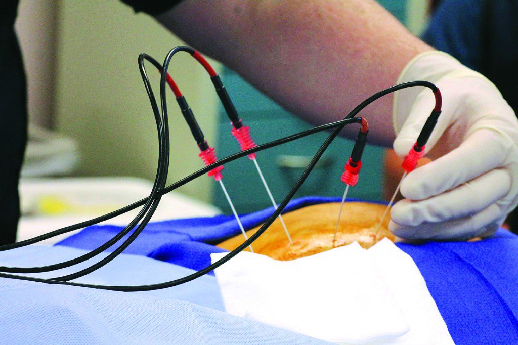 Radiofrequency Ablation Pros And Cons Vinmec Radiofrequency Ablation Pros And Cons Vinmec