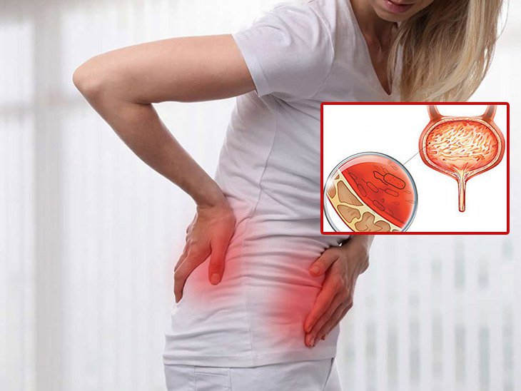 How to treat hemorrhagic cystitis? | Vinmec