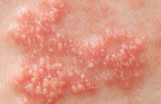 How to treat recurrent herpes simplex viral dermatitis? | Vinmec