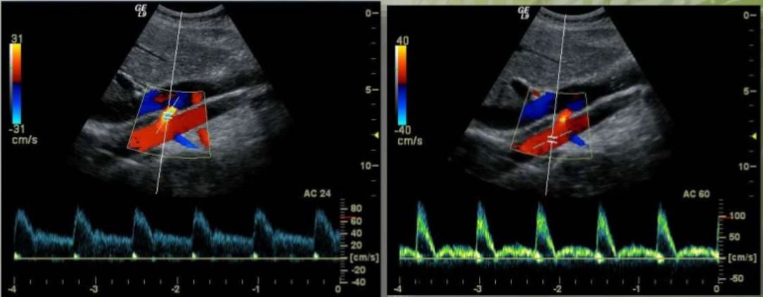 Doppler ultrasound of the renal arteries | Vinmec