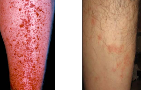 Pathogenesis of Helicobacter pylori and autoimmune skin diseases | Vinmec