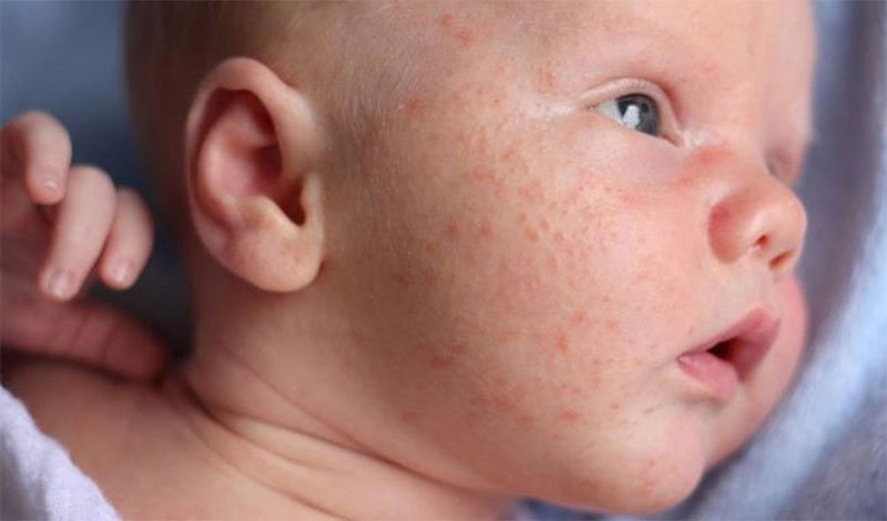 Heat rash in children | Vinmec