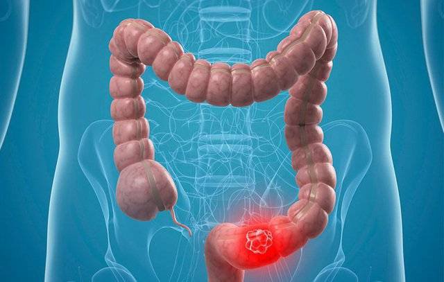 What is the result of X-ray of the colon with 2 abnormally shaped spots ...