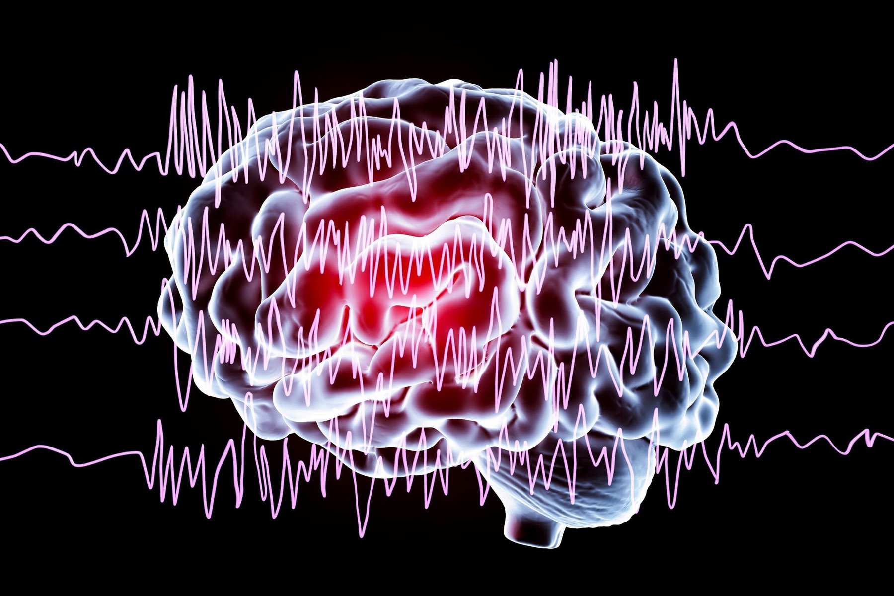 Is Epilepsy Hereditary Vinmec Is Epilepsy Hereditary Vinmec