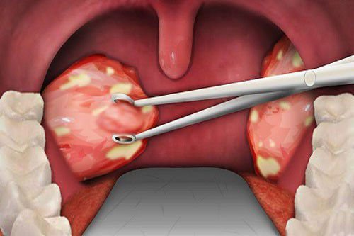 How is purulent tonsillitis treated? | Vinmec