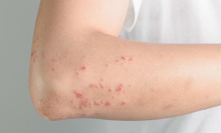 What are the signs of blistering with itchy skin? | Vinmec