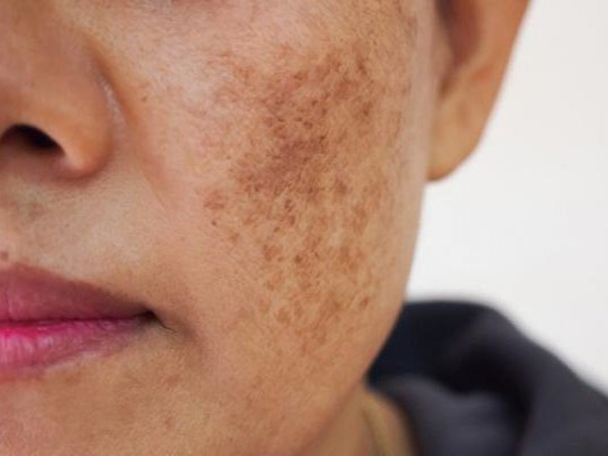 Da bị sạm đen- Nguyên nhân và cách chữa | Vinmec