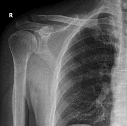 A Postoperative Xray Showing Right Acromioclavicular