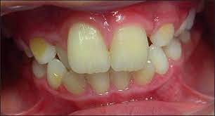 Macrodontia – Tình trạng răng to bất thường | Vinmec